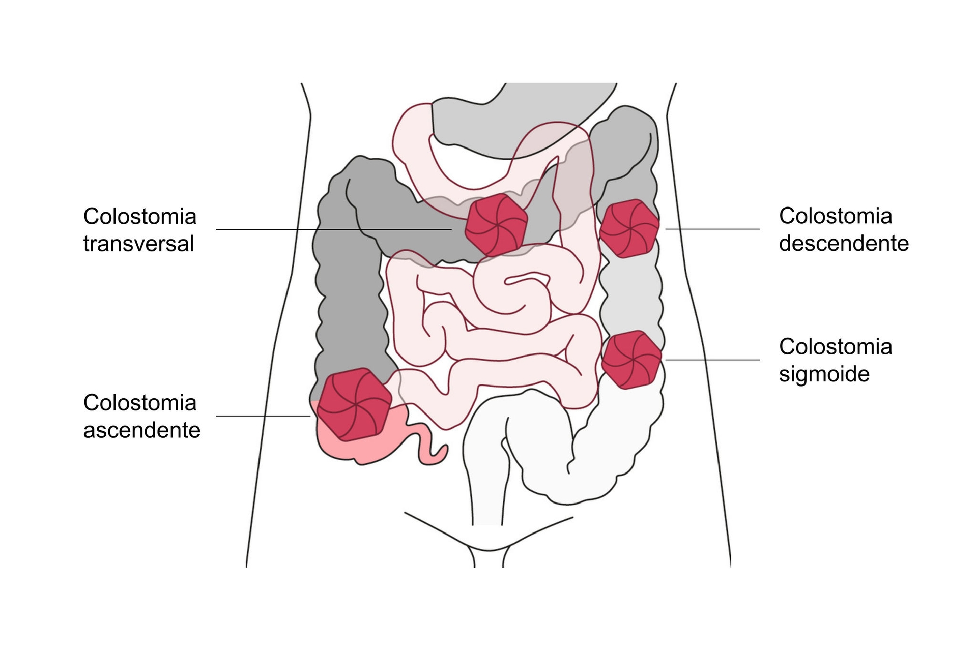 O que é um estoma? Explicação da função e tipos de ostomia