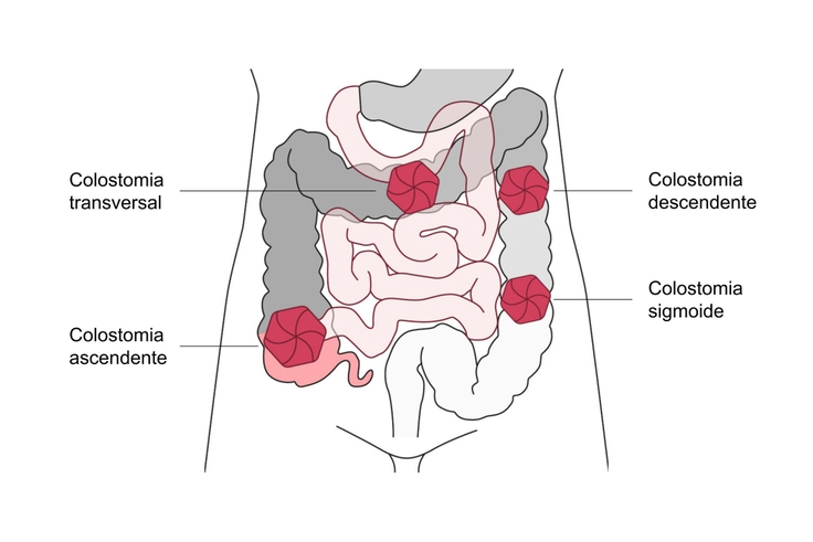 O que é um estoma? Explicação da função e tipos de ostomia