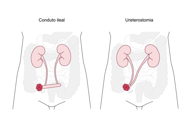 O que é um estoma? Explicação da função e tipos de ostomia
